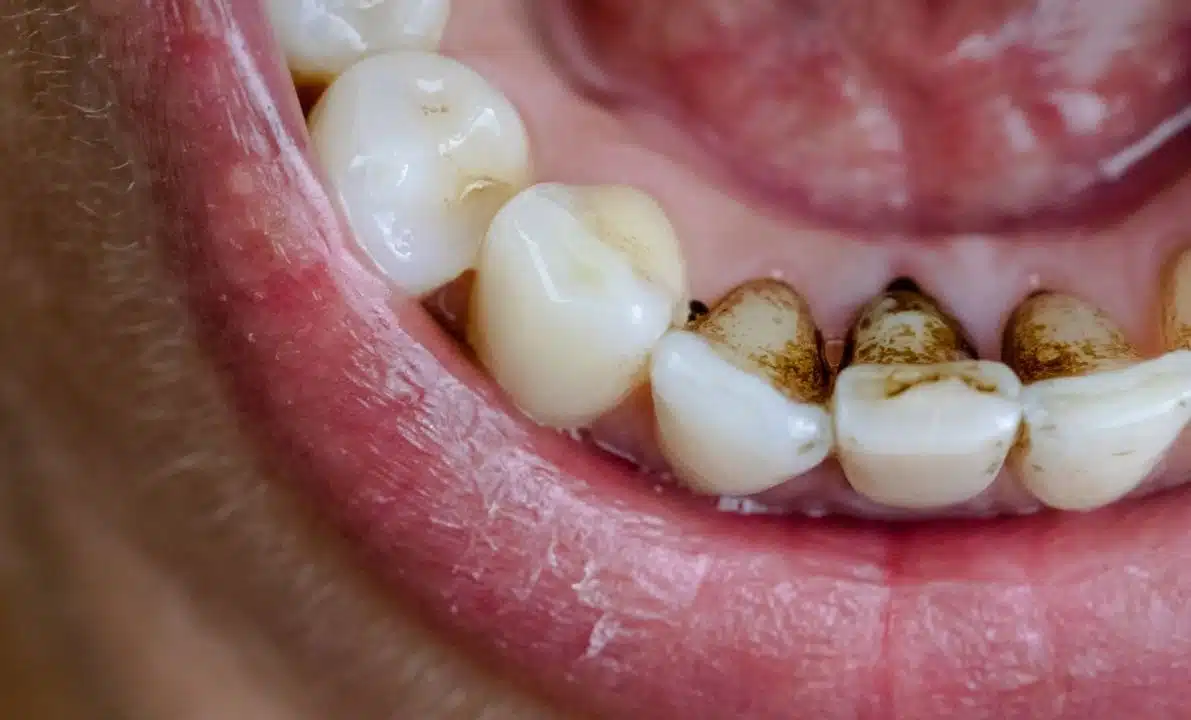 8 Easy Ways to Remove Food Stuck Between Your Teeth